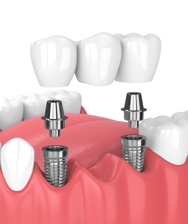 Step-by-Step Guide to the Dental Implant Procedure - Dentists in ...